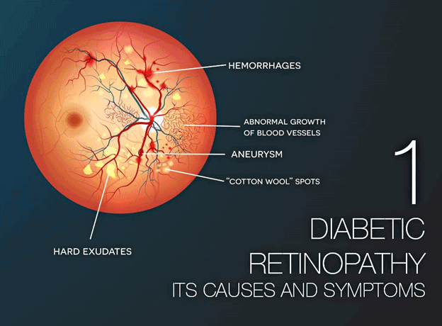 Diabetic Retinopathy Part 1 Its Causes And Symptoms Fairfax Va